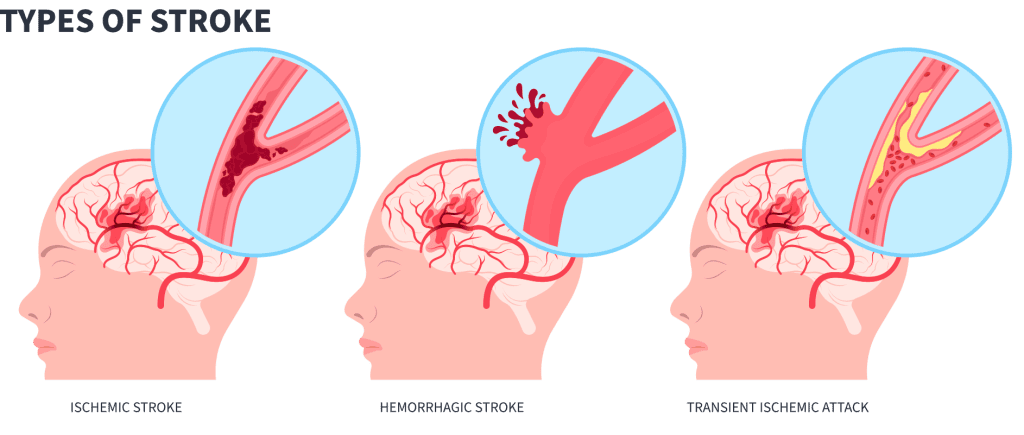 Stroke | Centre for Neuro Skills
